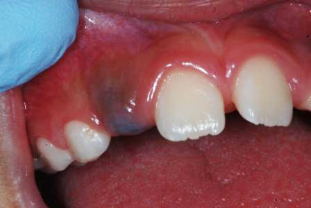 Permanent Tooth Eruption in Children - Lonestar Kid’s Dentistry
