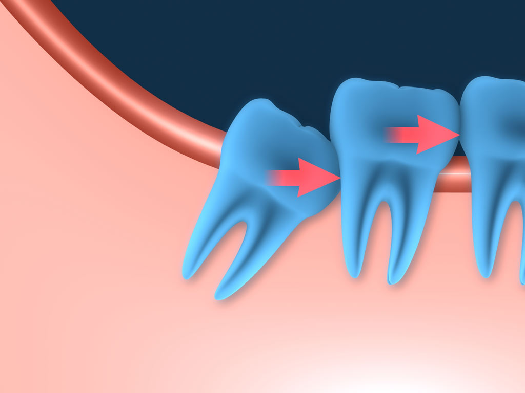 Wisdom Teeth in Teenagers - Lonestar Kid’s Dentistry