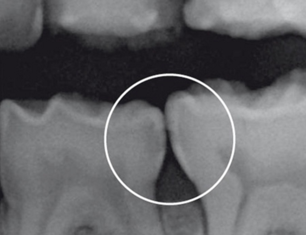 Frisco Kids DDS Dental X-rays in Children are Safe