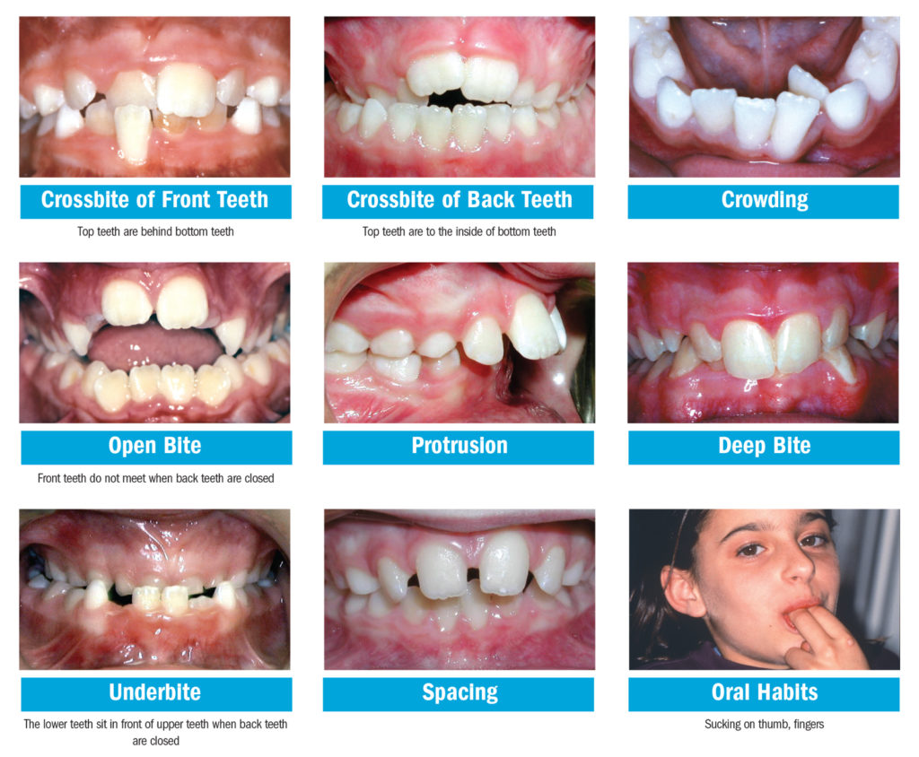 When should kids get braces? - Lonestar Kid’s Dentistry