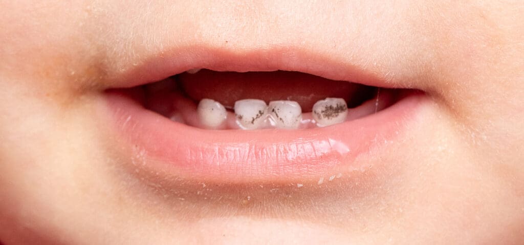 Toddler tooth decay | Pediatric Dentist | Lonestar Kid’s Dentistry ...