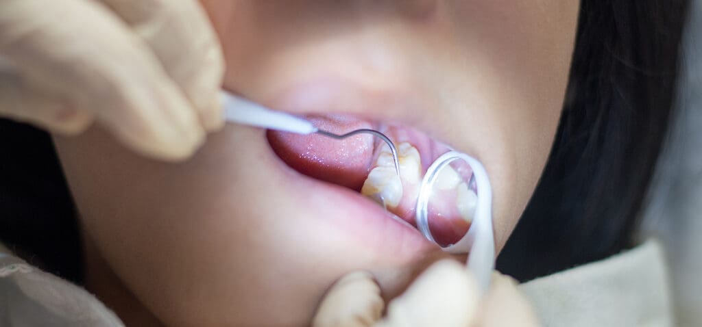 Children’s dental crowns | Pediatric Dentist | Lonestar Kids Dentistry Mckinney TX