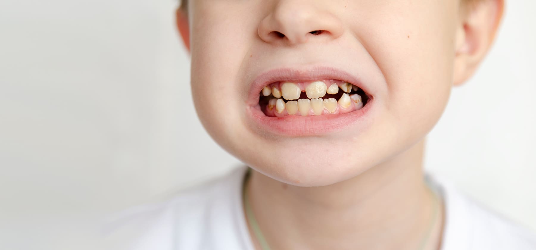 Hypoplastic tooth enamel treatment | Pediatric Dentist Prosper